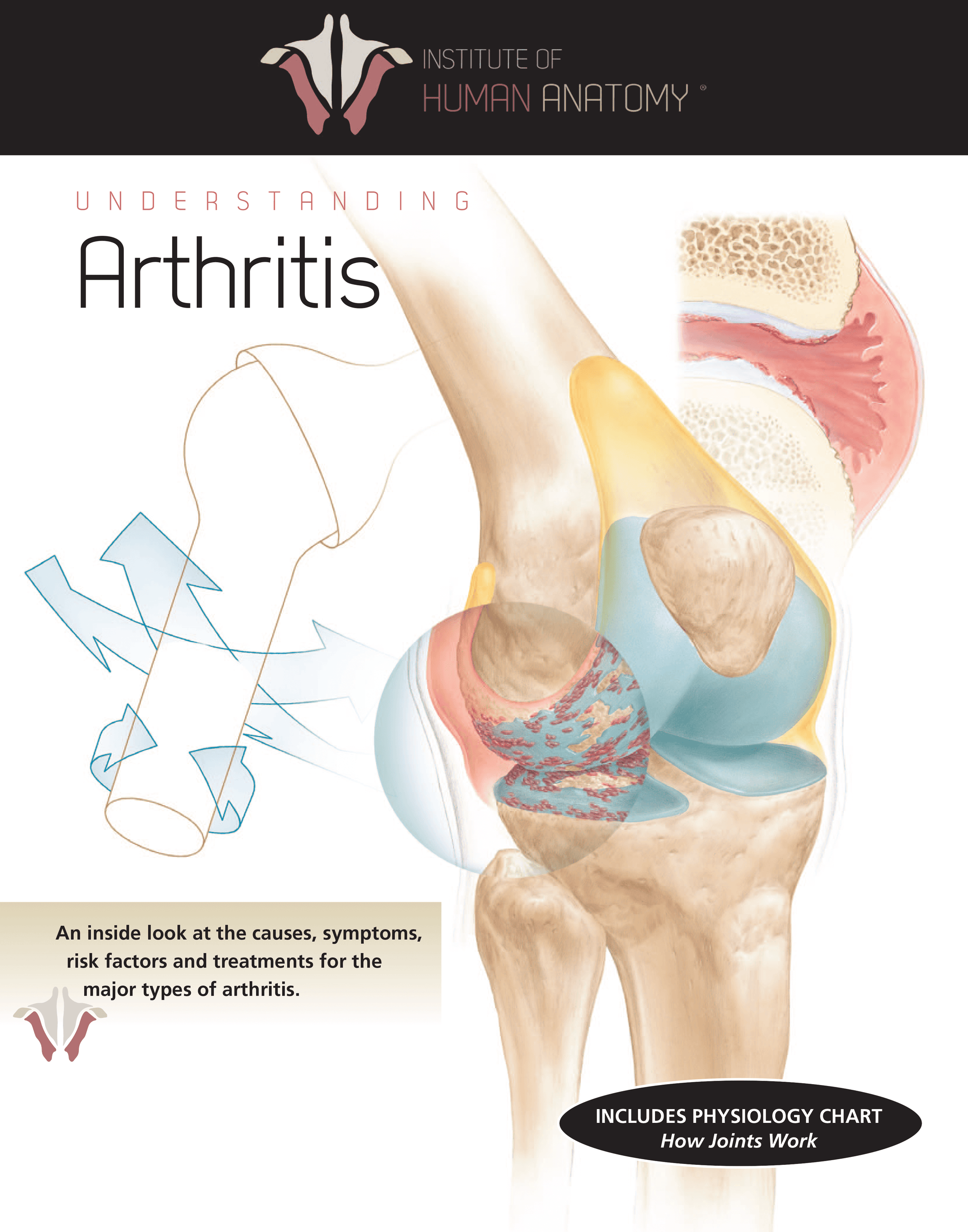 Understanding Arthritis - eBook